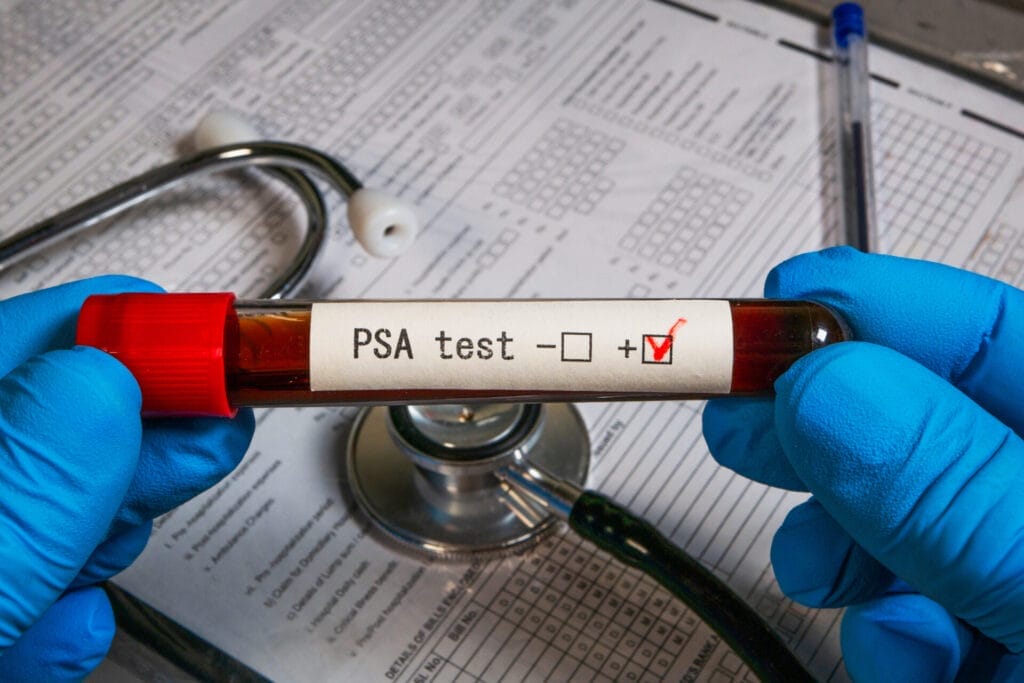Prostate Cancer Screening Guide Men | Early Detection